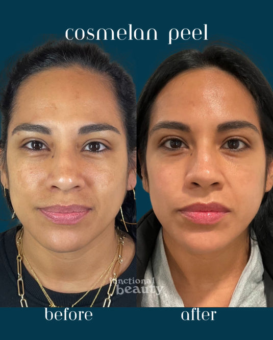 Cosmelan Peel | Treat Dark Spots & Pigmentation in Ventura & Moorpark ...