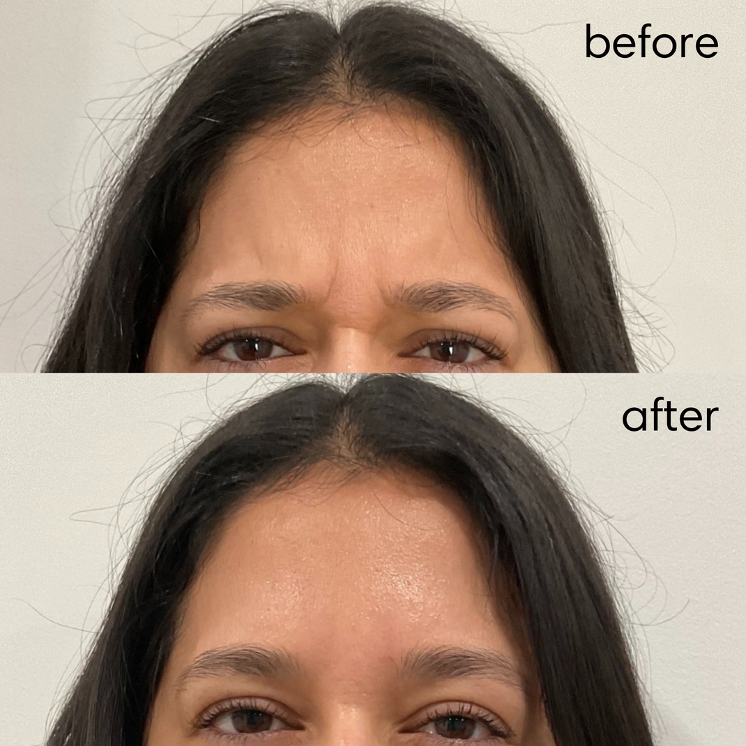 Wrinkle Relaxers | Botox, Dysport & More at Functional Beauty ...